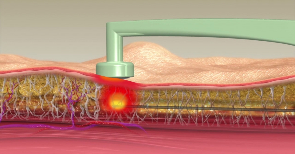 “Tite” Procedures by InMode